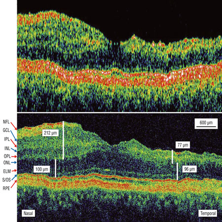 Assessment of Retinal Thinning in Adults With and Without Sickle Cell ...