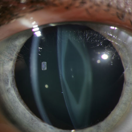 Visual Acuity and Ophthalmic Outcomes in the Year After Cataract ...