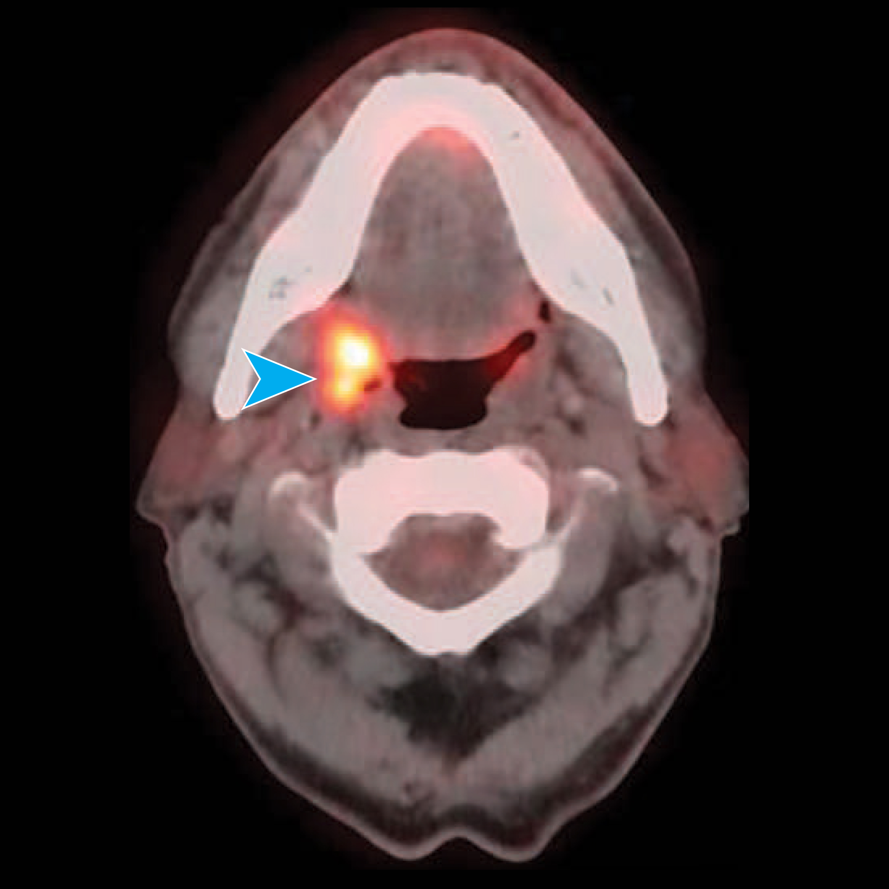 JAMA Oncology : Treatment Deescalation With Radiotherapy vs Transoral ...